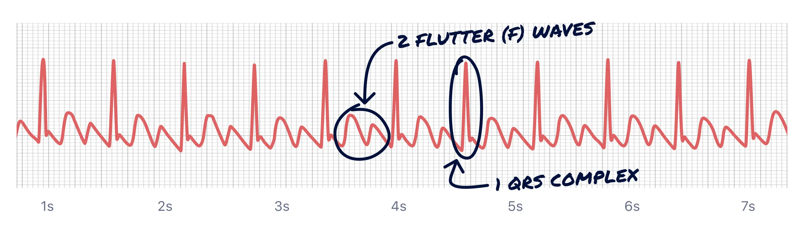 What Atrial Flutter Looks Like On Your Watch Ecg Qaly